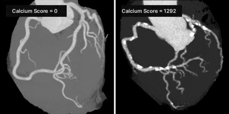 Calcium Score Procedure In Singapore | The Heart Practice Clinic